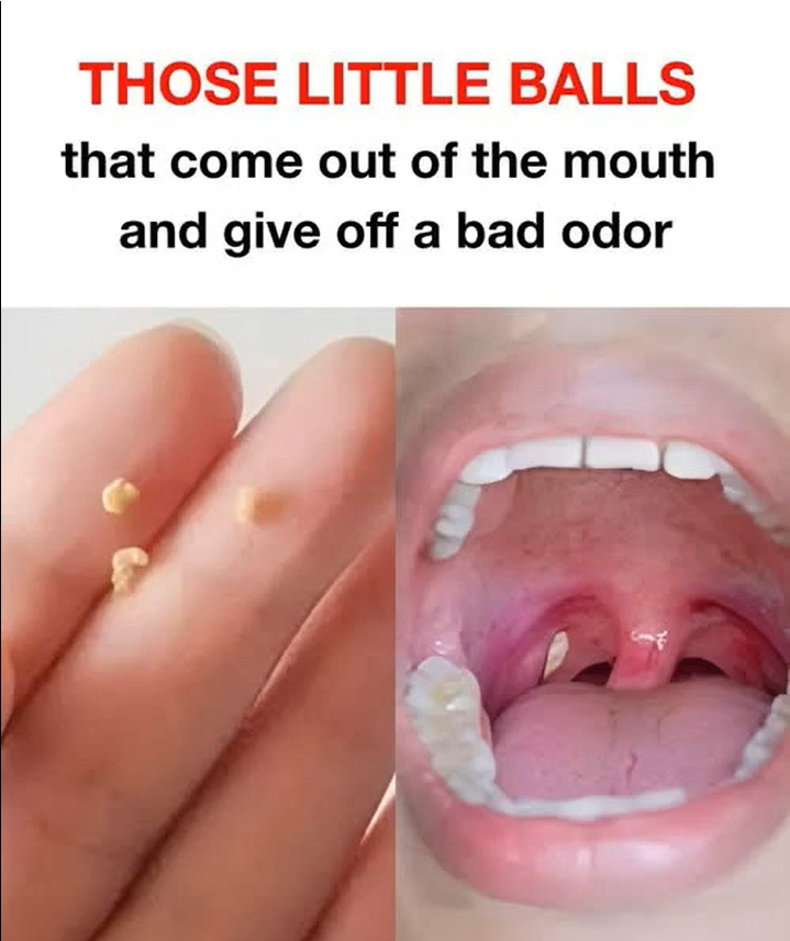 Understanding Tonsil Stones: Causes of the Smell and Effective Ways to ...
